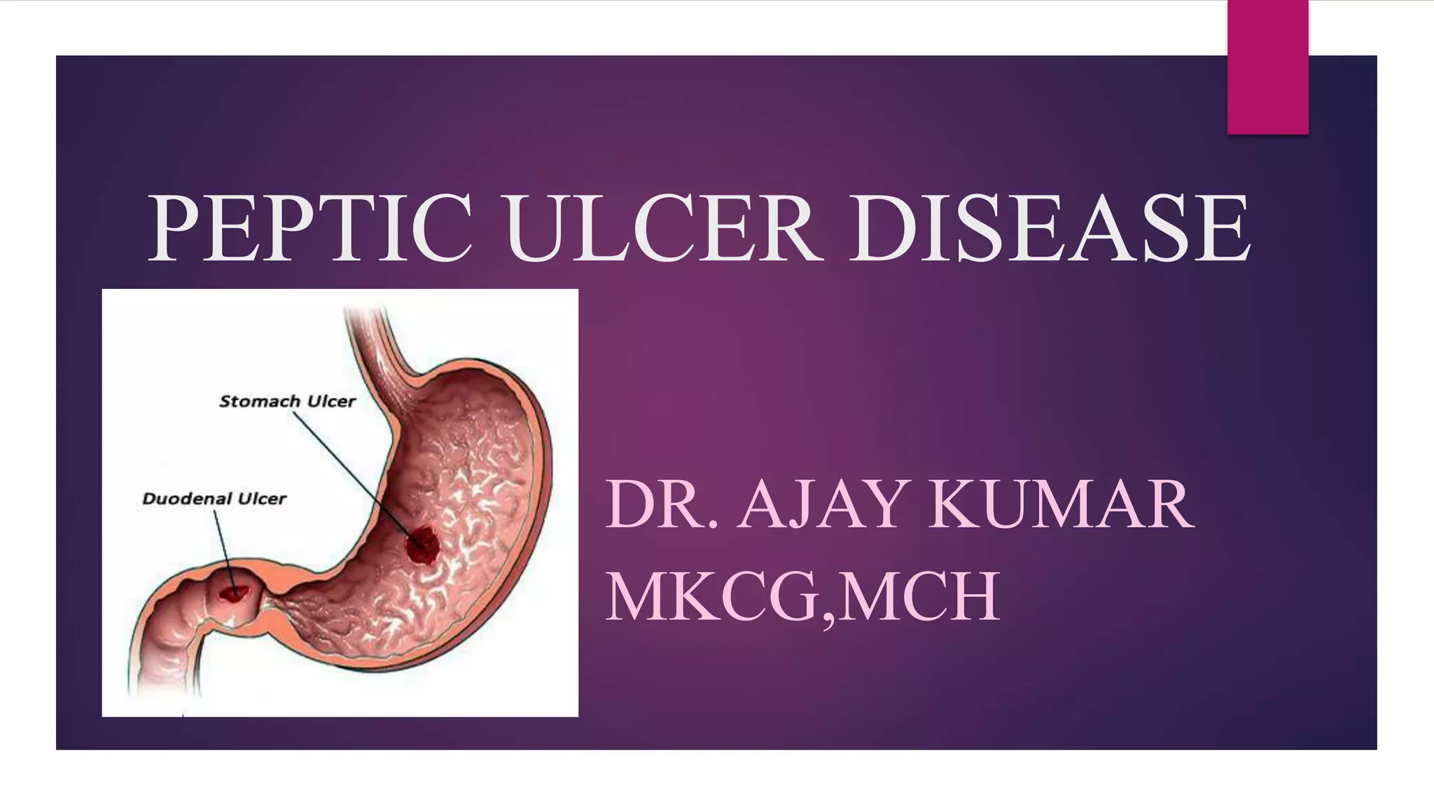 Peptic ulcer disease | PPTX