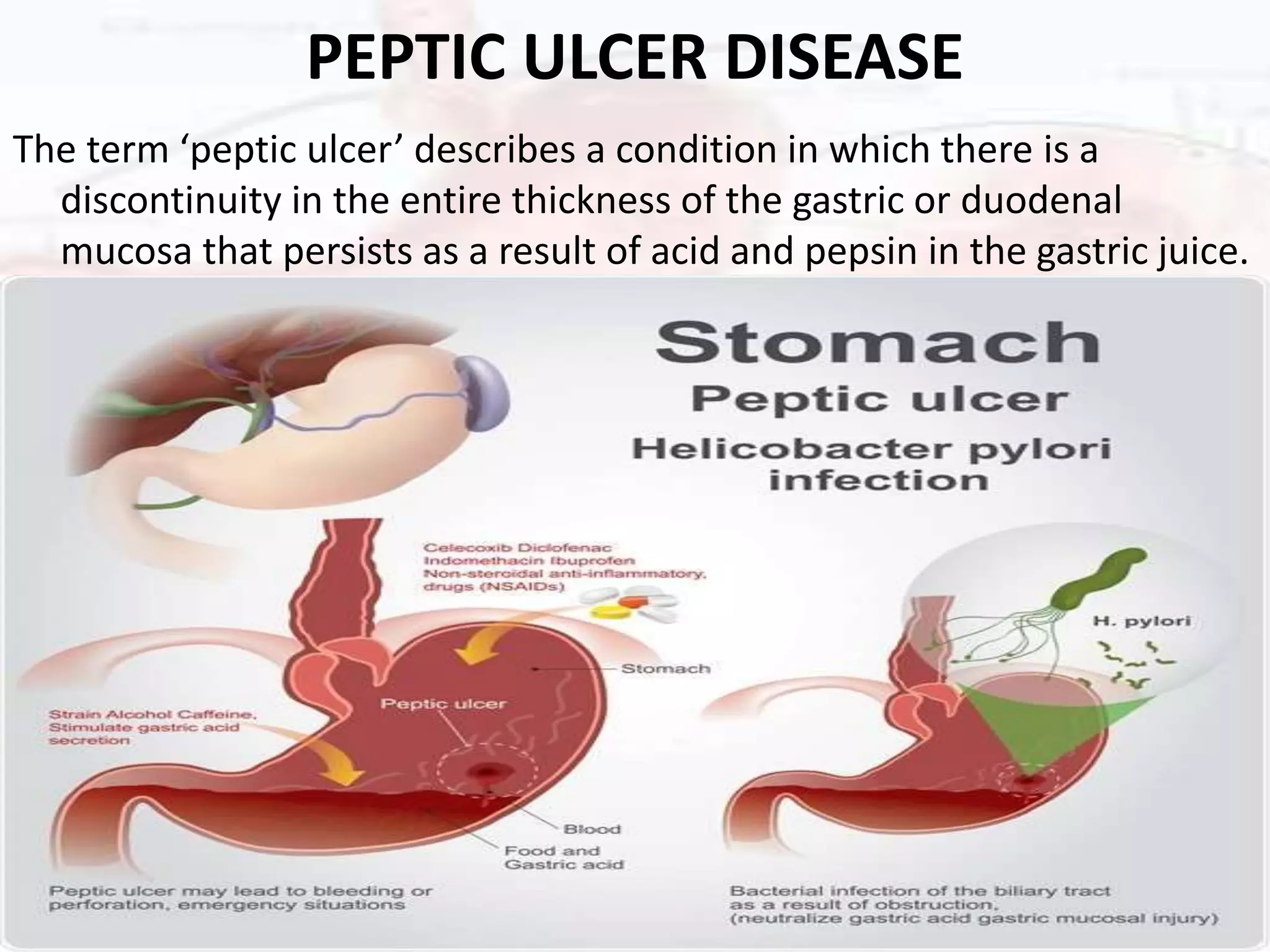 Peptic ulcer disease | PPTX