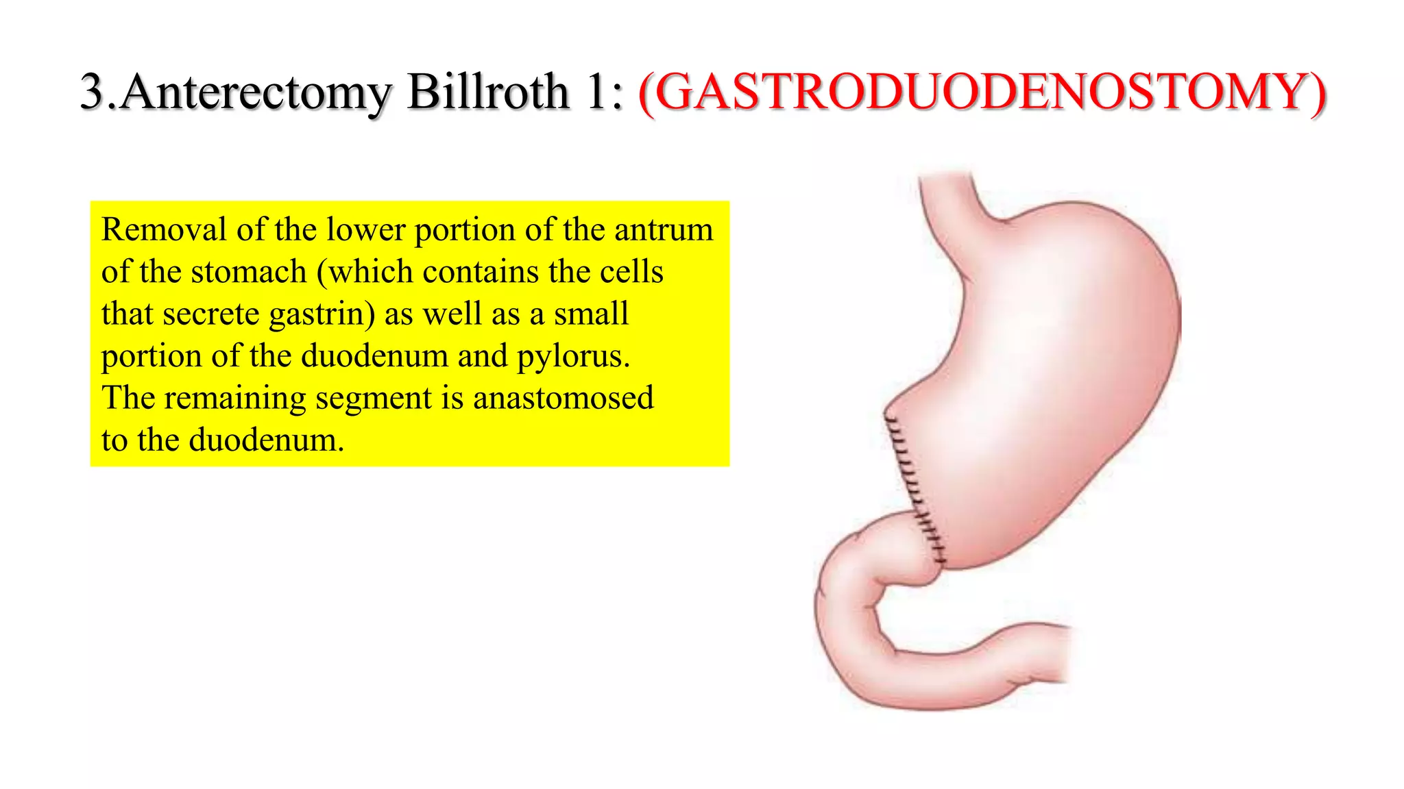Peptic Ulcer Disease Ppt
