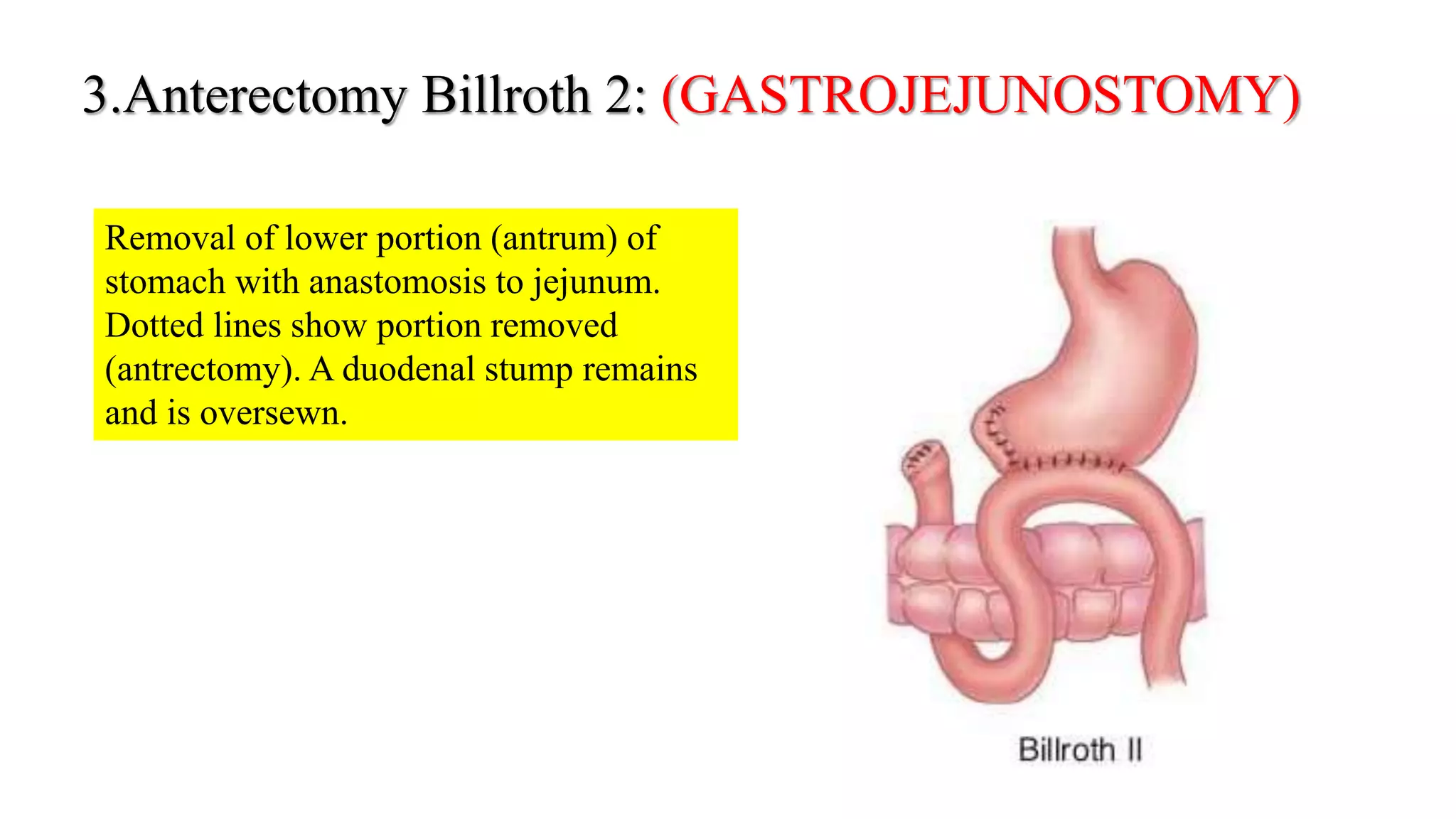 Peptic Ulcer Disease Ppt