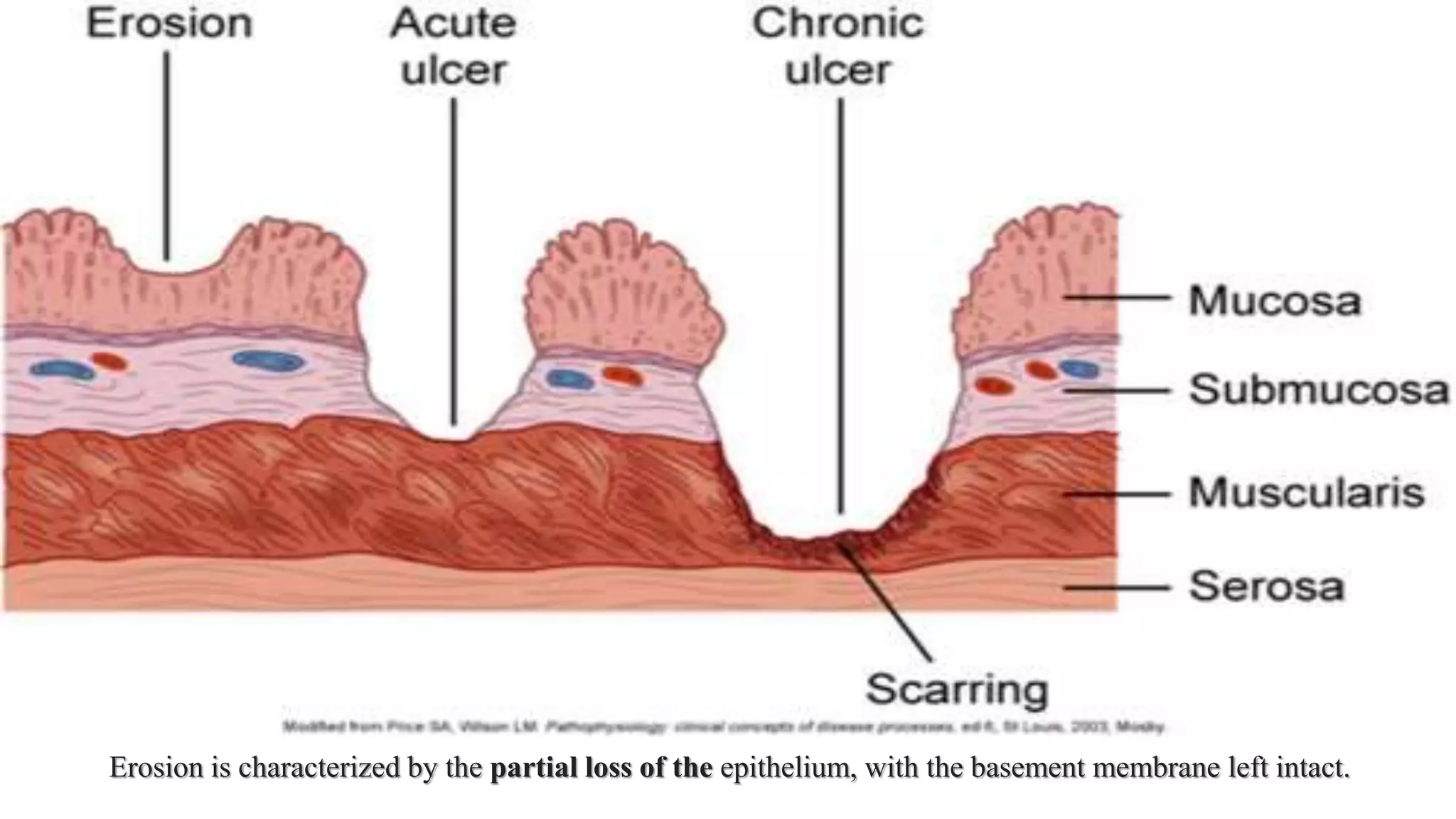 Peptic ulcer disease | PPTX