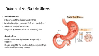 Peptic Ulcer Disease.pptx