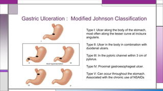 Peptic Ulcer Disease.pptx