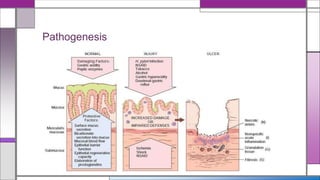 Peptic Ulcer Disease.pptx