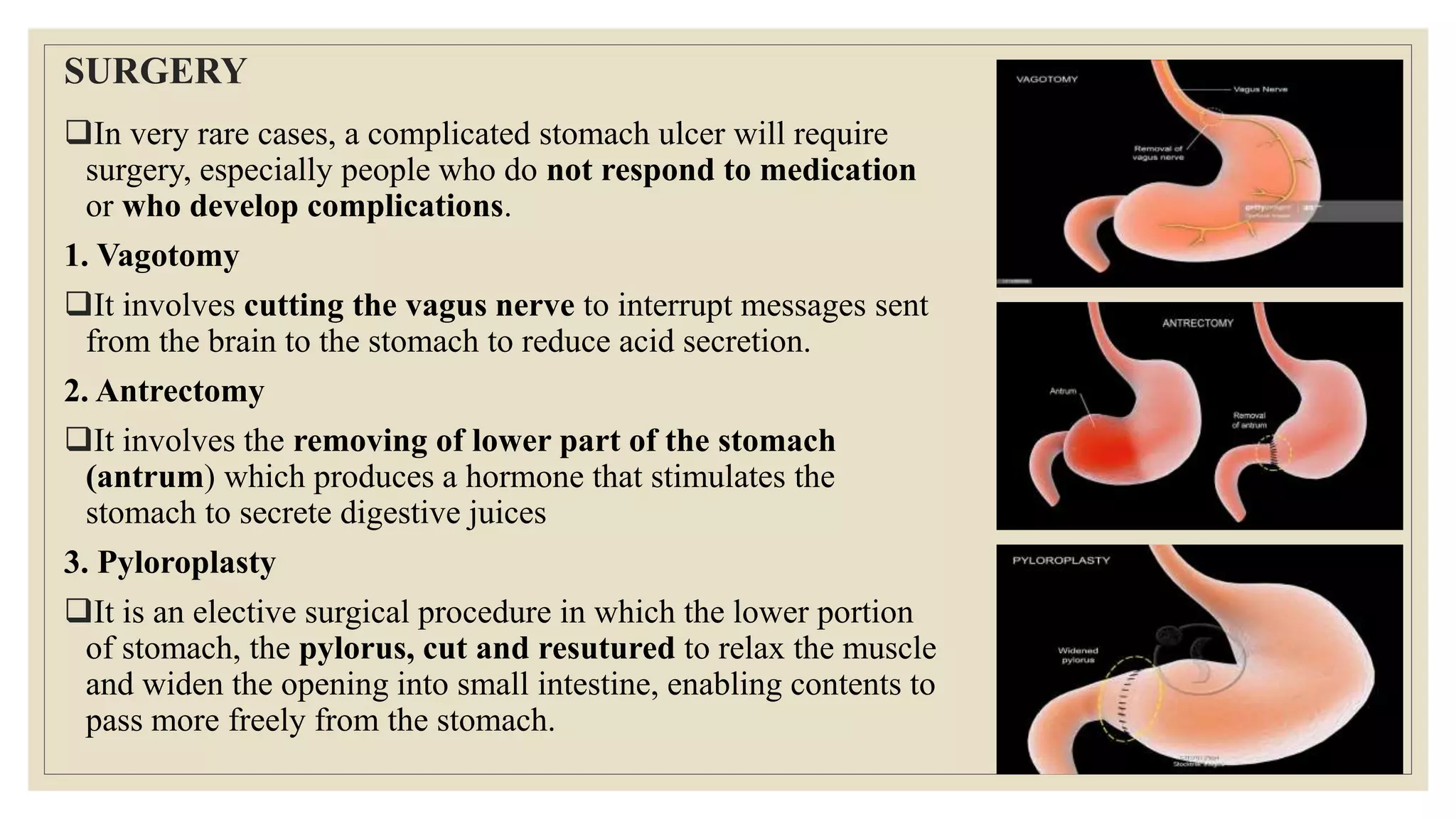 Peptic ulcer disease | PPTX