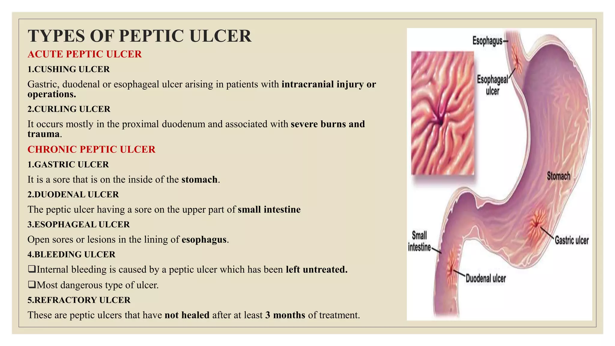 Peptic ulcer disease | PPTX