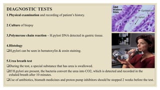 Peptic ulcer disease | PPTX