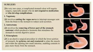 Peptic ulcer disease | PPTX