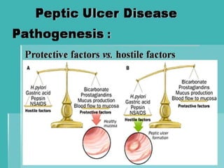 Peptic ulcer disease.pptx