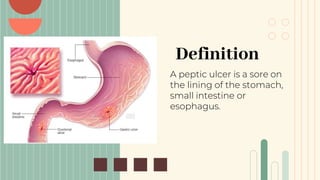 peptic ulcer disease.pptx
