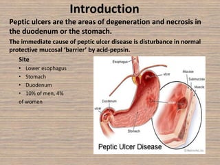 peptic_ulcer_disease.ppt | Free Download