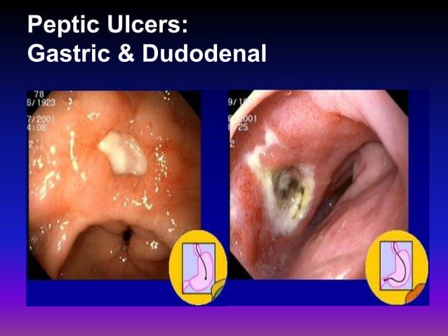 PEPTIC ULCER Disease for the human health .ppt