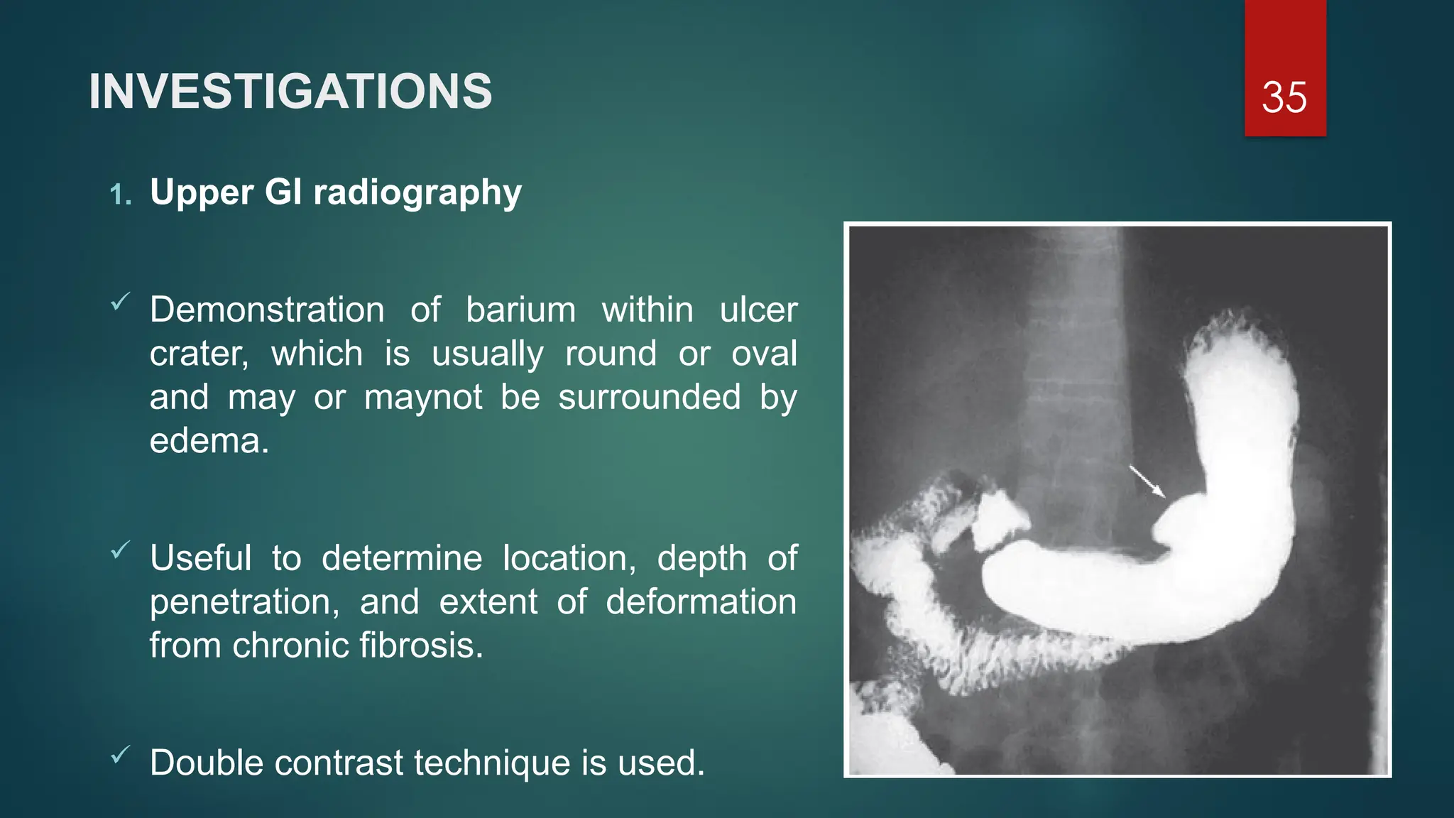 PEPTIC ULCER DISEASE medical management.pptx