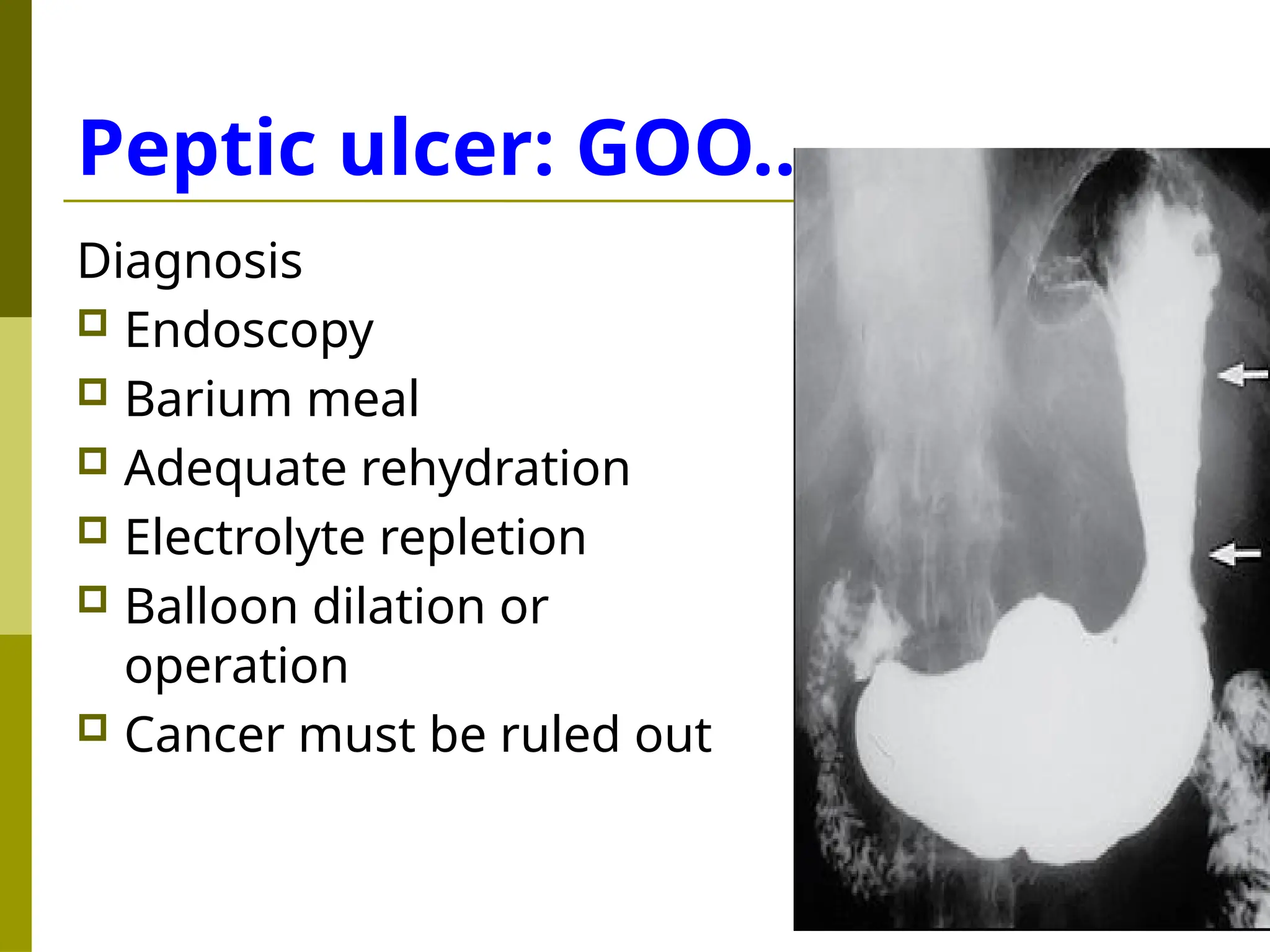Peptic ulcer disease.pptx duodenum ulcer | PPT