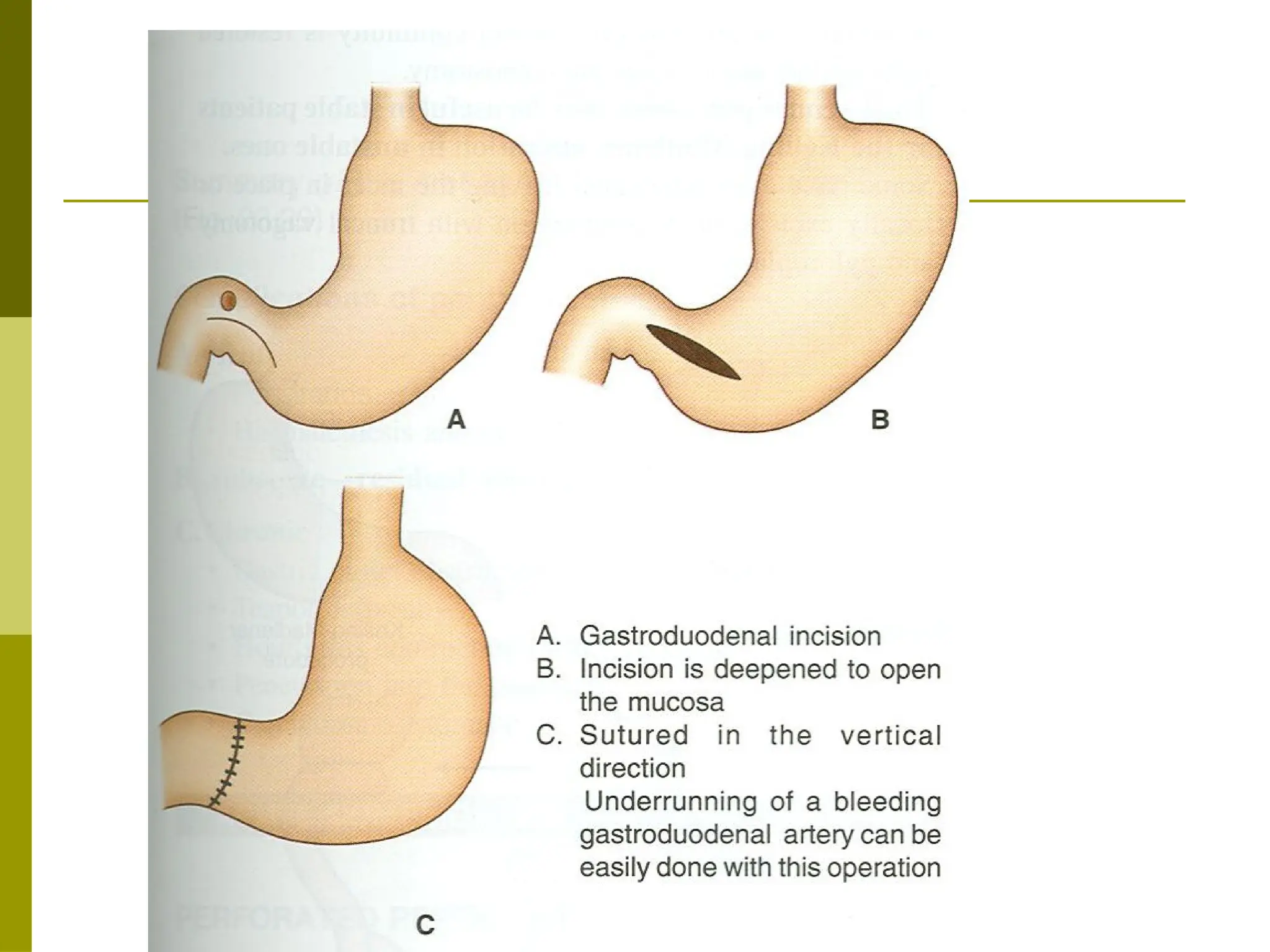 Peptic ulcer disease.pptx duodenum ulcer | PPT