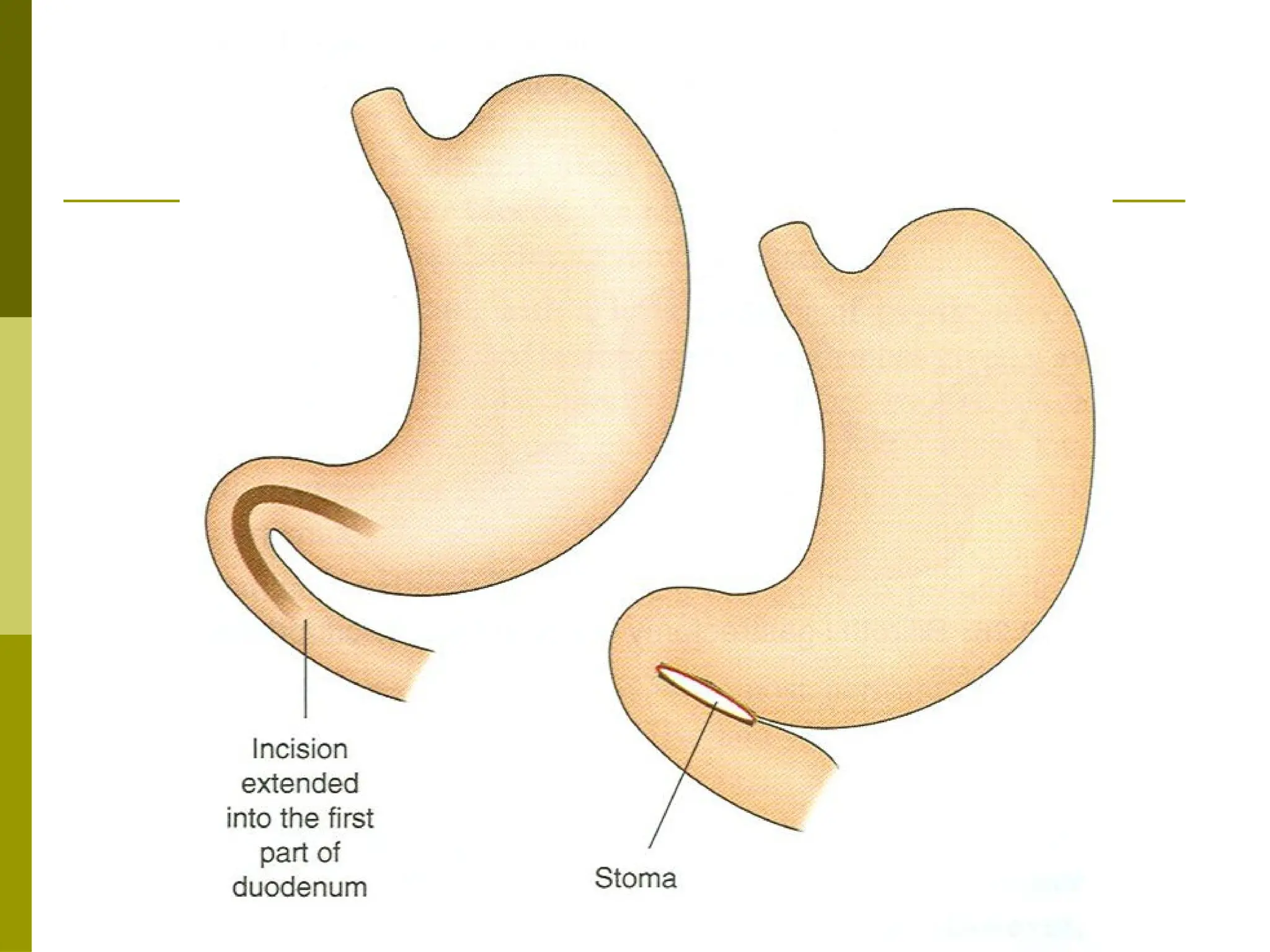 Peptic ulcer disease.pptx duodenum ulcer | PPT