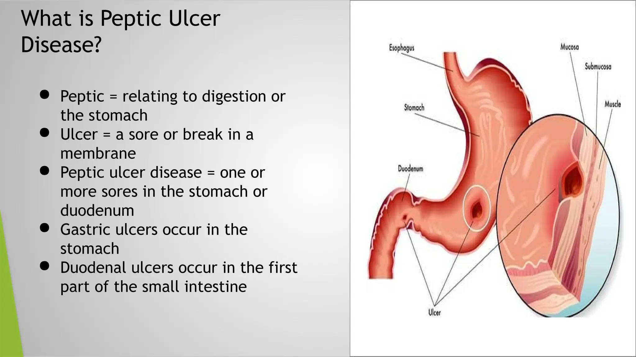 PEPTIC ULCER DISEASE,NURSING AND MEDICAL MANAGEMENT | PPTX
