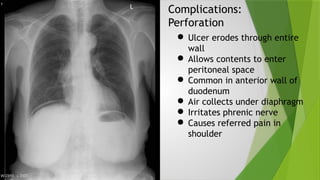 PEPTIC ULCER DISEASE,NURSING AND MEDICAL MANAGEMENT | PPTX