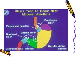 peptic ulcer disease. Power point presentation.ppt