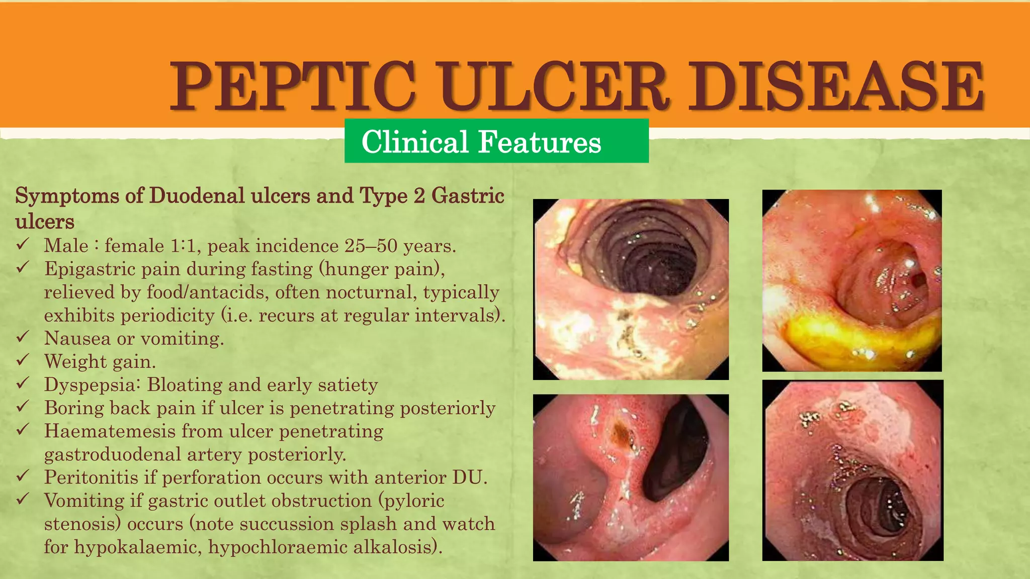 Peptic ulcer disease/ Epigastric pain | PPTX