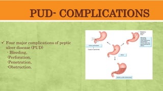 Peptic ulcer disease/ Epigastric pain | PPTX