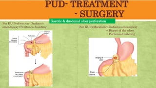 Peptic ulcer disease/ Epigastric pain | PPTX