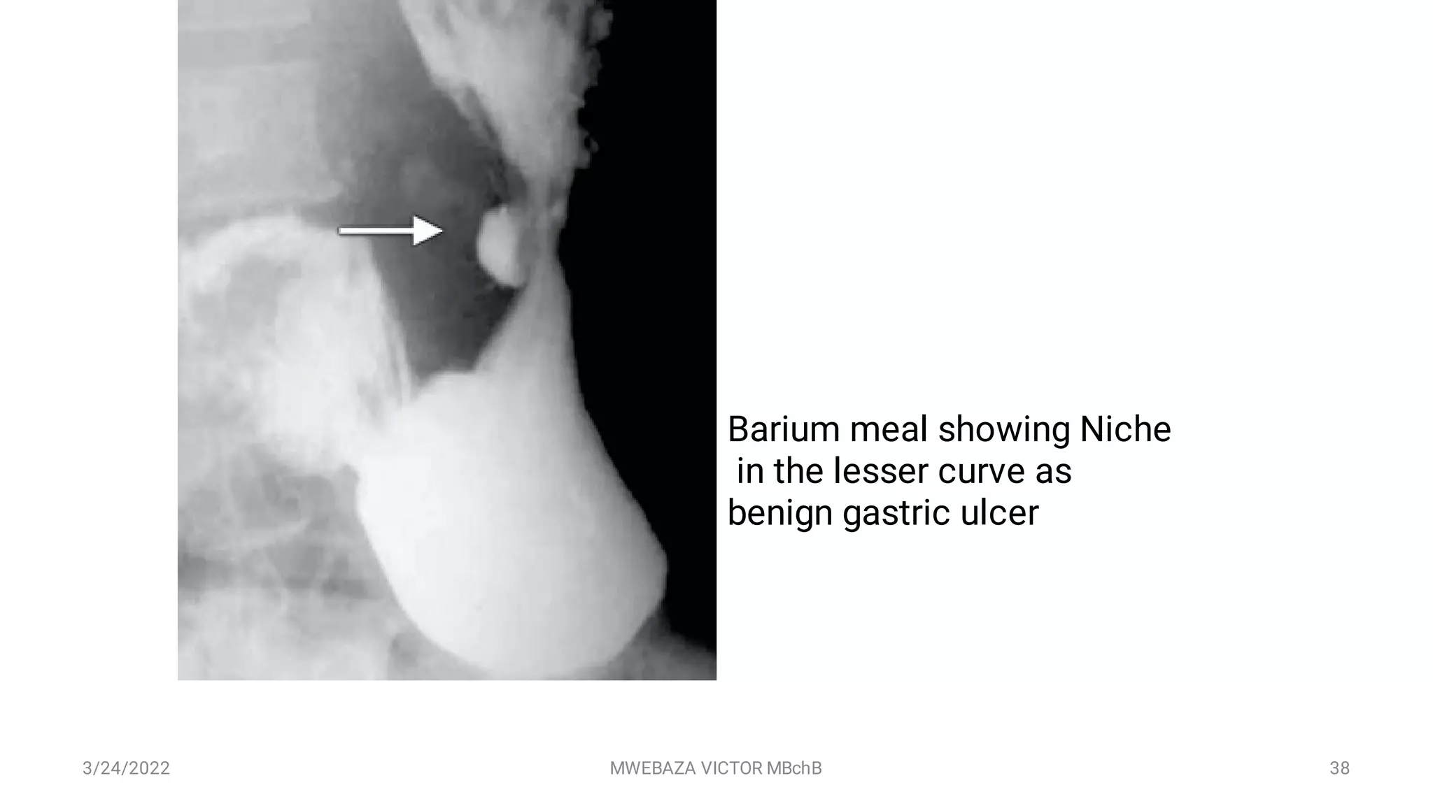 Peptic Ulcer Disease- MWEBAZA VICTOR pdf | PDF