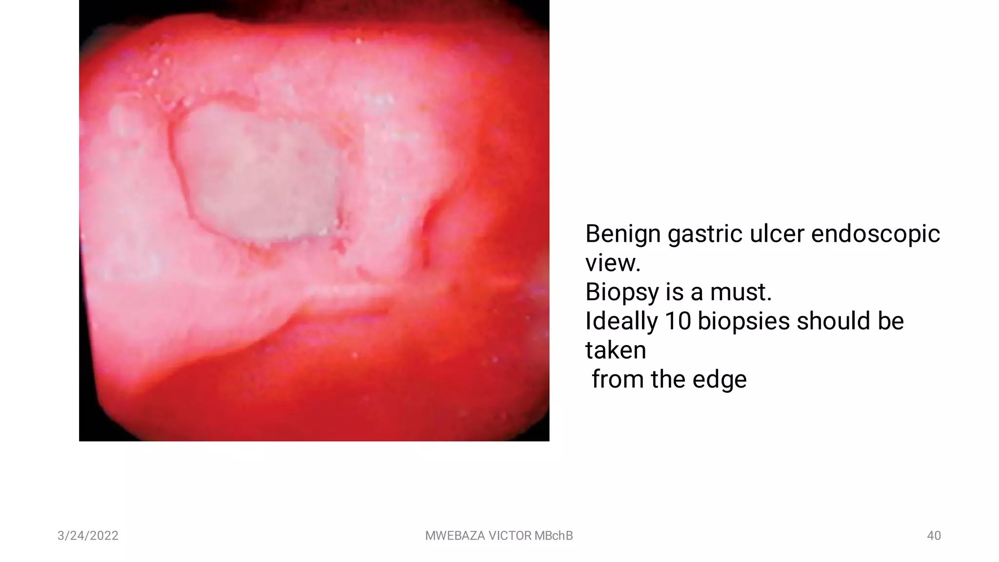 Peptic Ulcer Disease- MWEBAZA VICTOR pdf | PDF