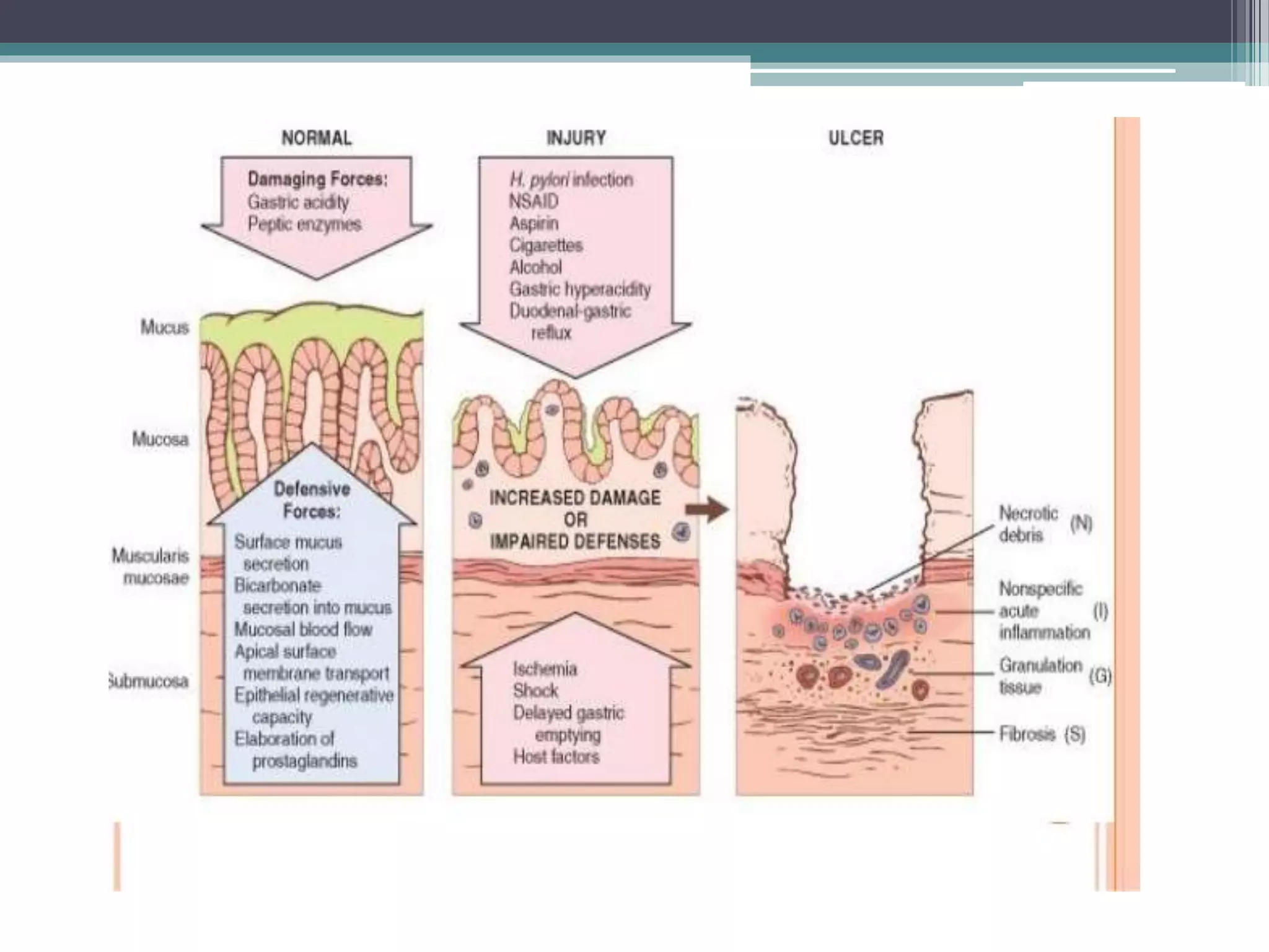 Peptic ulcer disease by dr shubhanshi | PPT