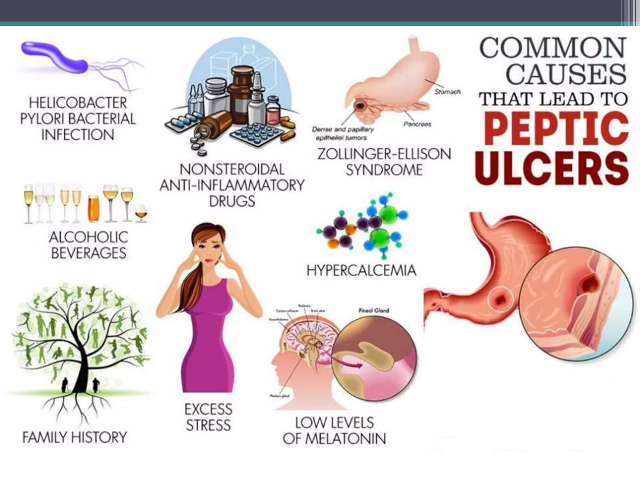 Peptic ulcer disease by dr shubhanshi | PPT