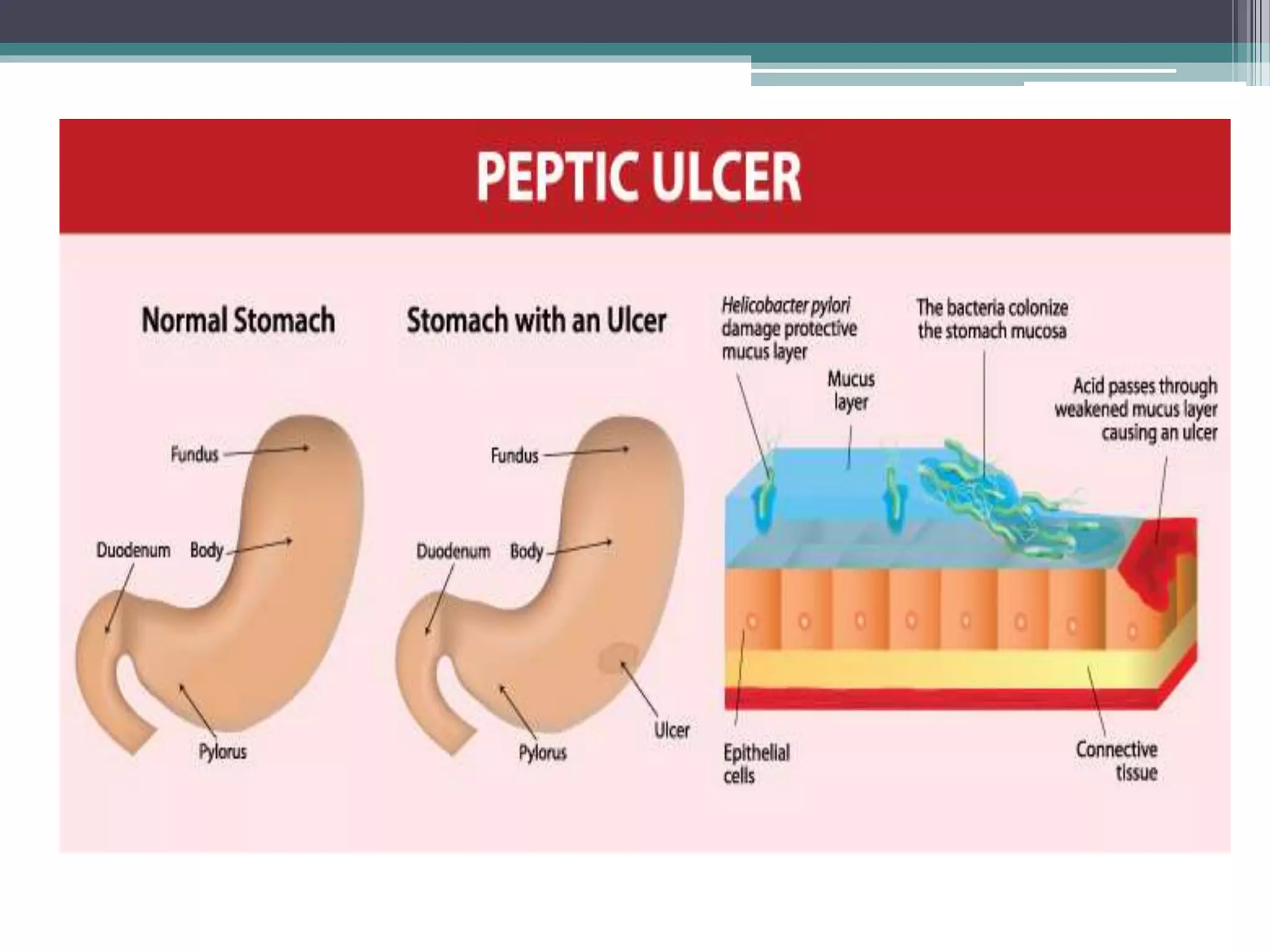 Peptic ulcer disease by dr shubhanshi | PPT