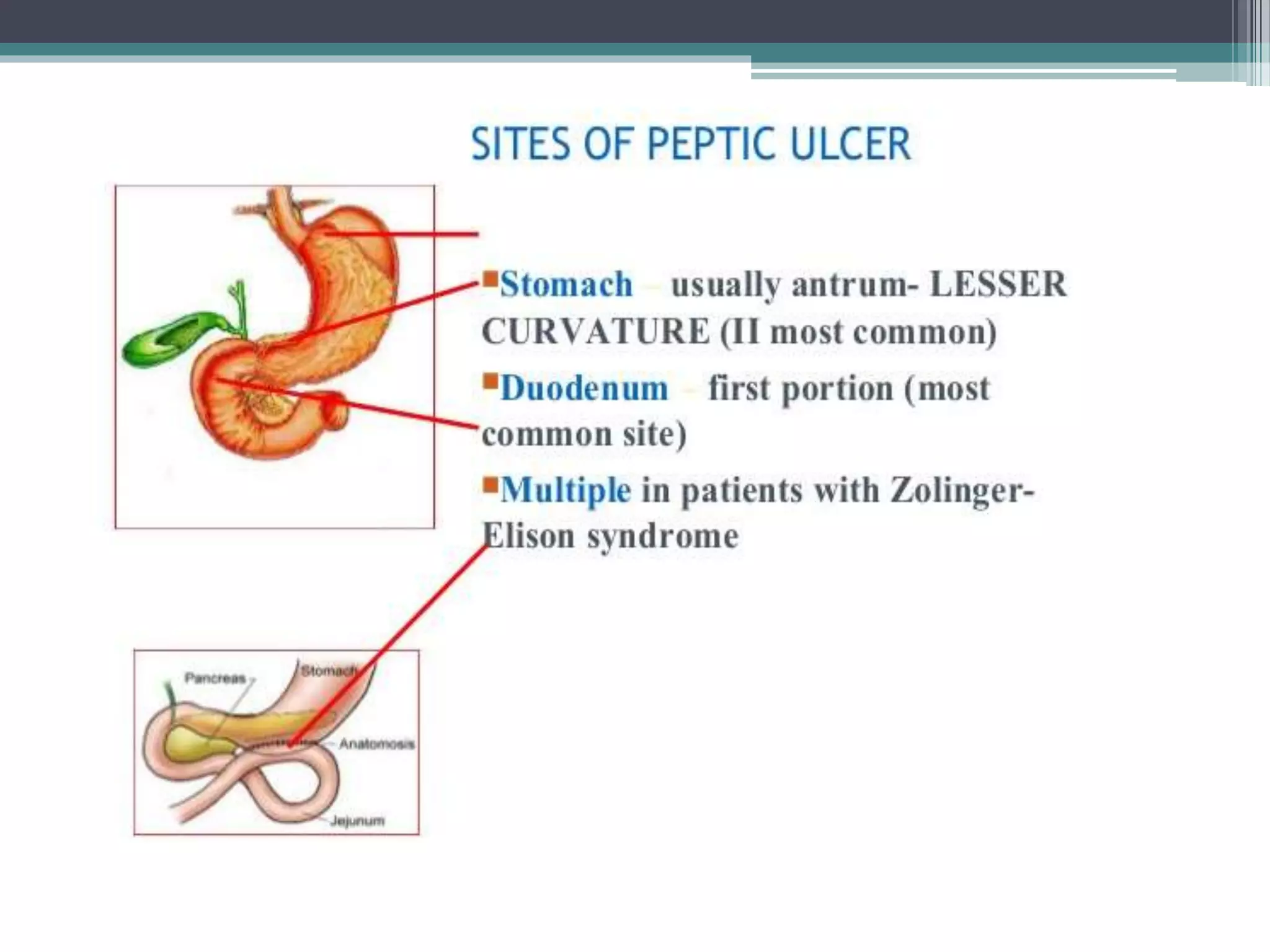 Peptic ulcer disease by dr shubhanshi | PPT