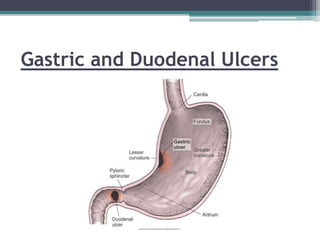 Peptic ulcer disease by dr shubhanshi | PPT