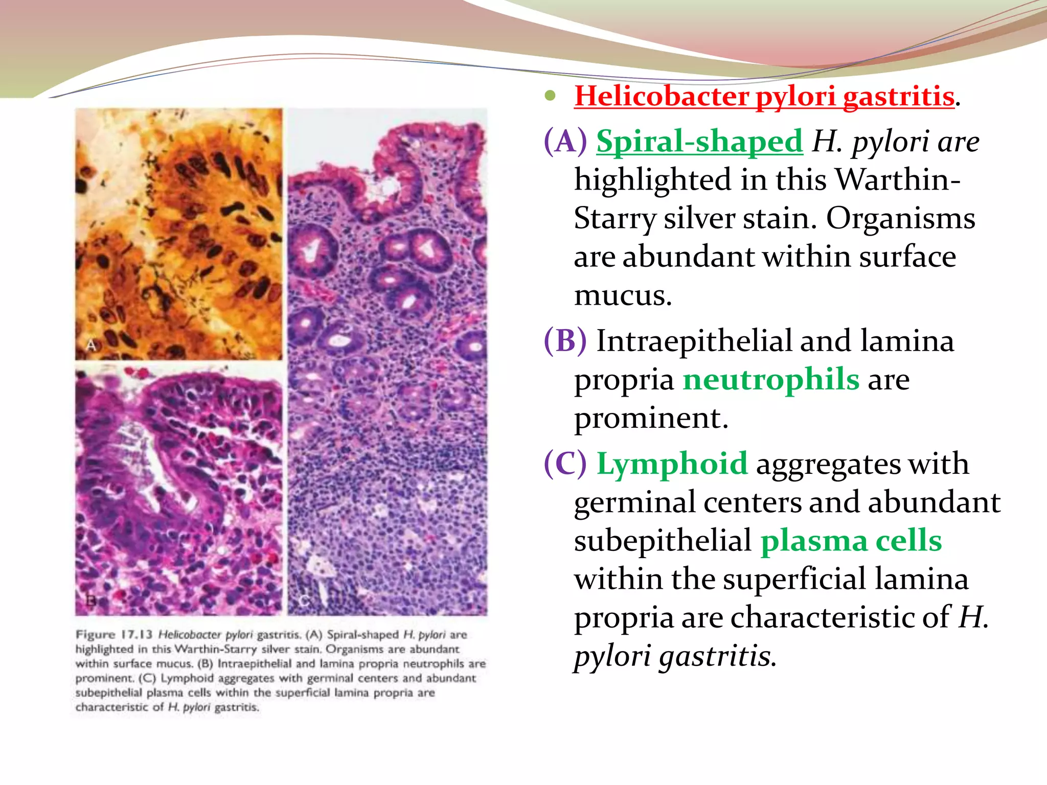Peptic Ulcer Disease DG.pptx