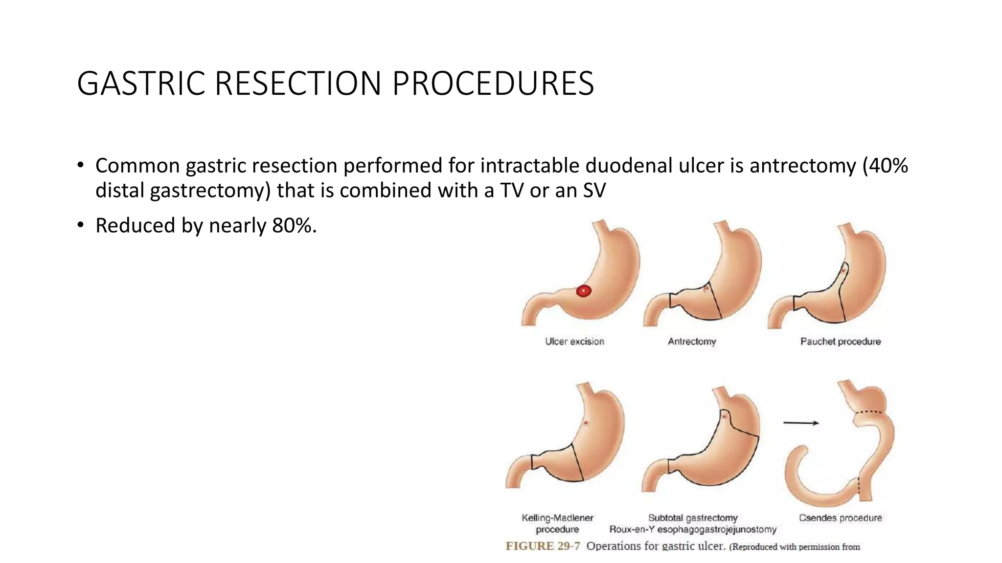 Peptic ulcer disease management | PPTX