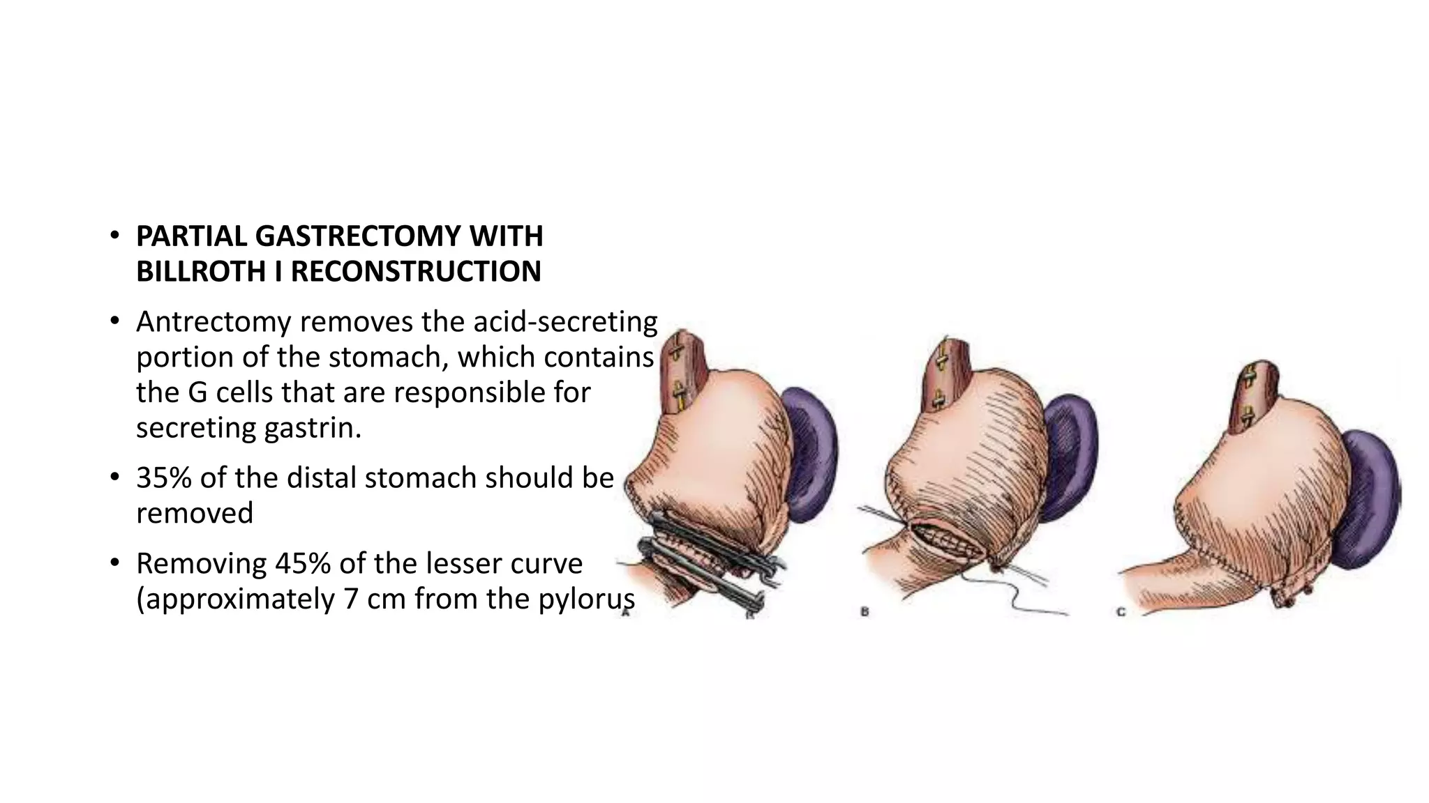 Peptic ulcer disease management | PPTX