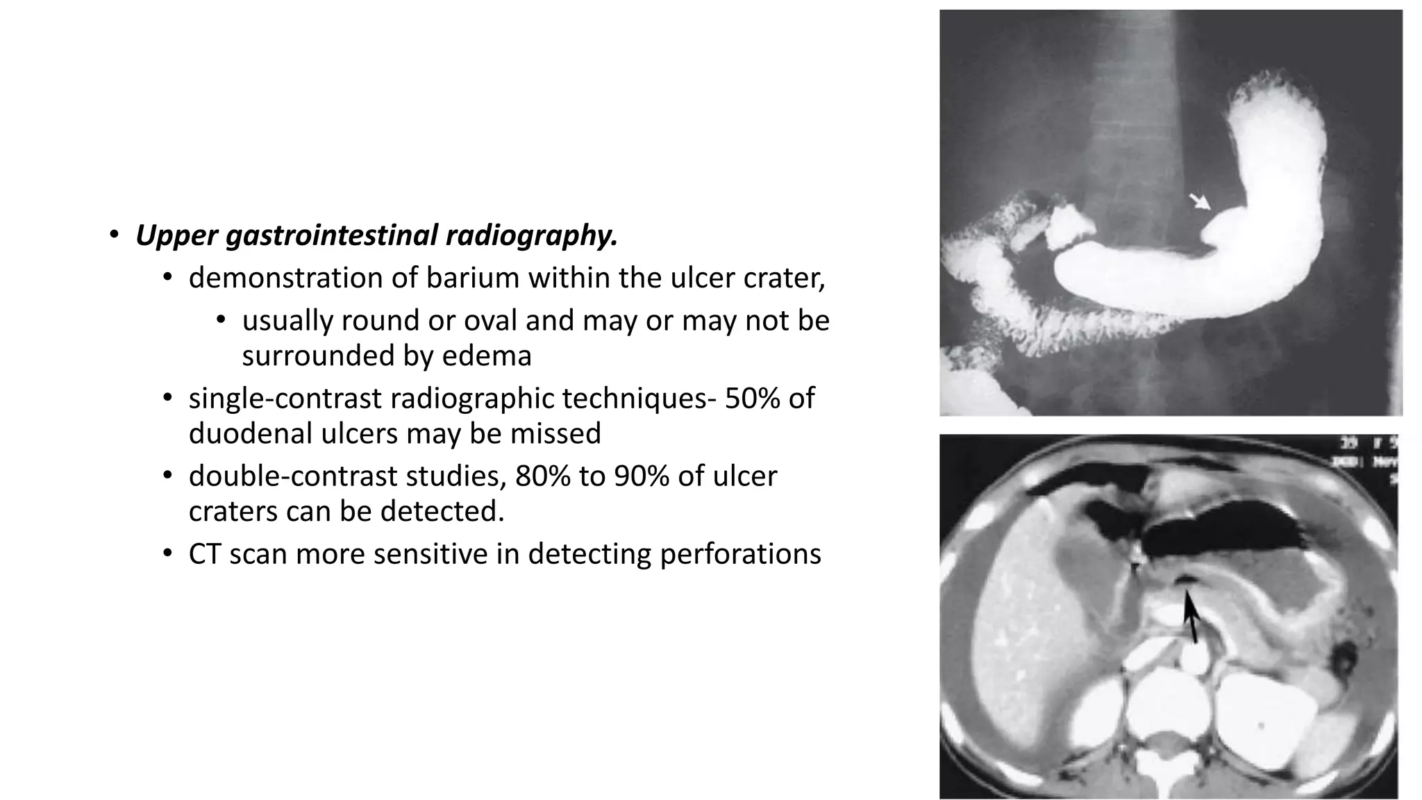 Peptic ulcer disease management | PPTX