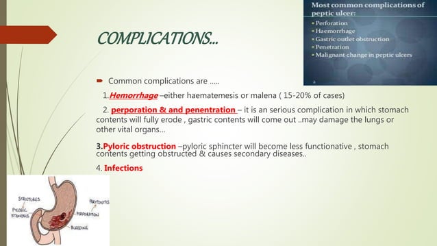 PEPTIC ULCER DISEASE MANAGEMENT MURUGESH.pptx
