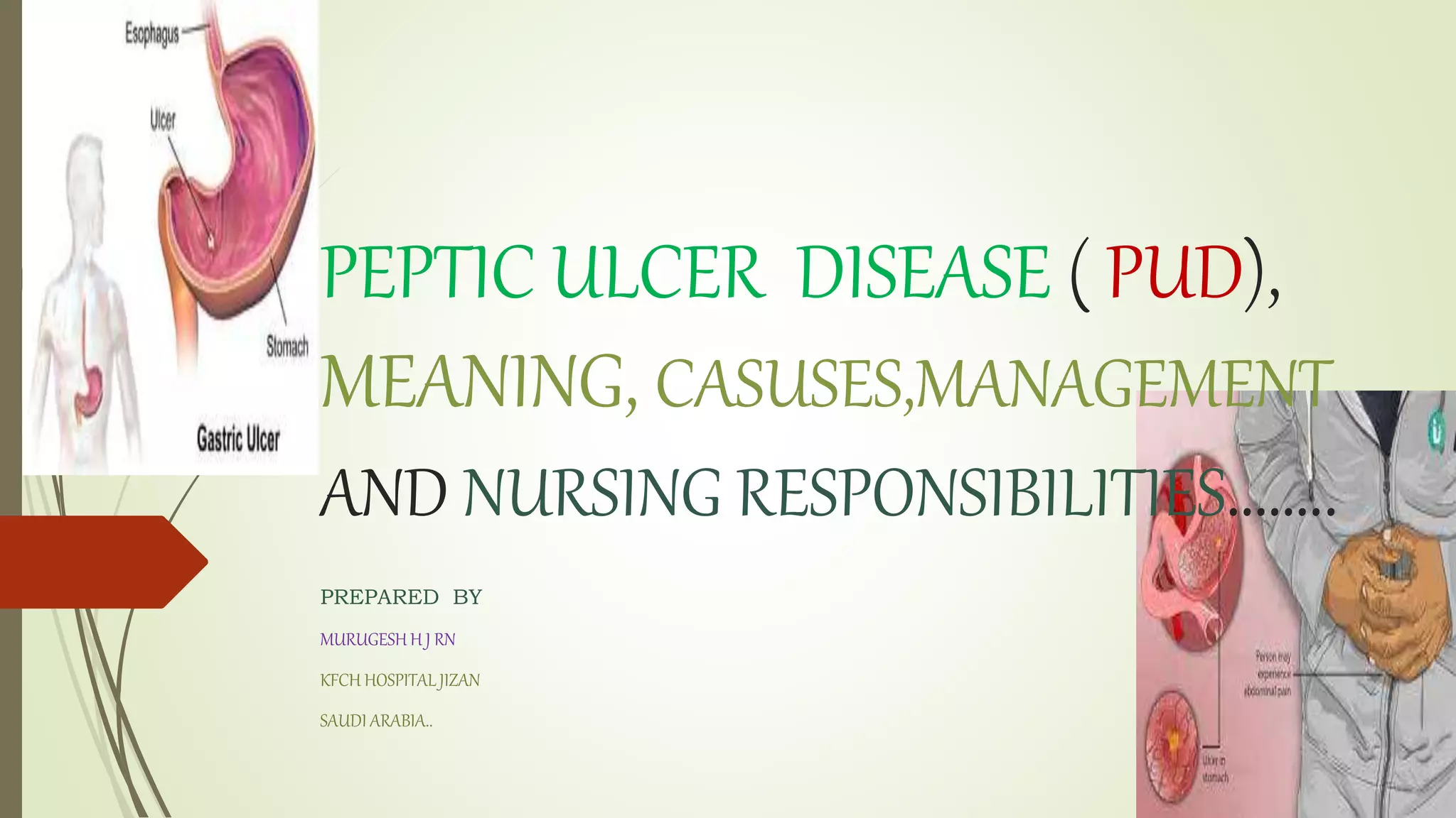 PEPTIC ULCER DISEASE MANAGEMENT MURUGESH (1).pptx