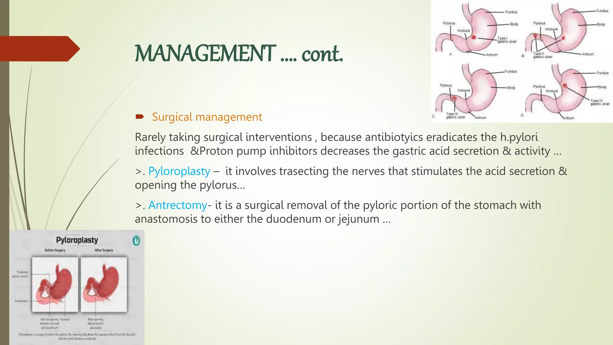 PEPTIC ULCER DISEASE MANAGEMENT MURUGESH (1).pptx