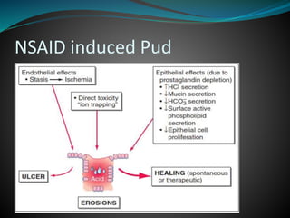 Peptic ulcer disease(PUD) | PPTX