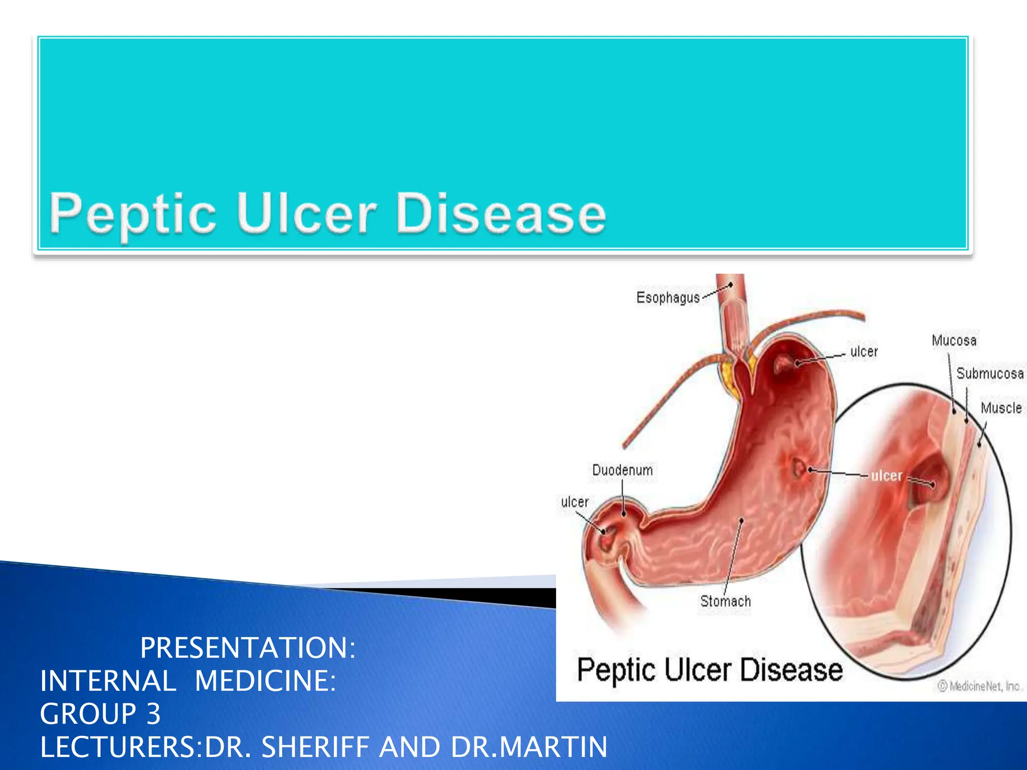 Peptic ulcer diseases-2.pptx444444444444 | PPTX