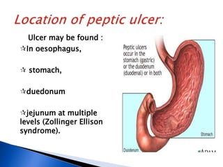 Peptic ulcer diseases-2.pptx444444444444 | PPTX