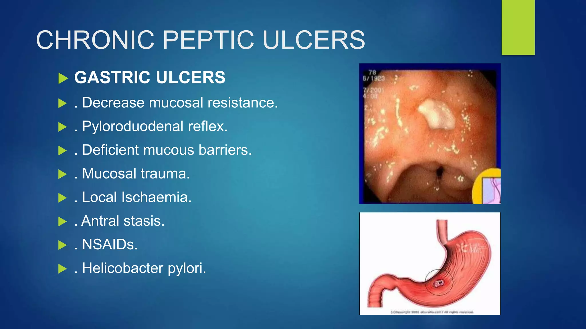 Peptic ulcer drugs | PPTX
