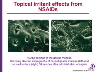 Peptic ulcer management in the era of nsaid | PPT
