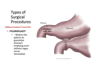 peptic ulcer mohammad abu sad 1.pptx