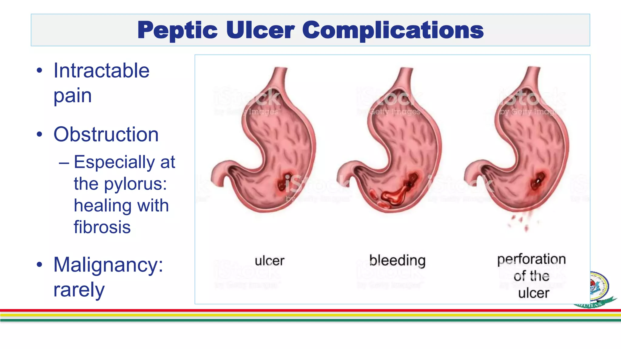 Peptic ulcer pathophysiology | PPTX