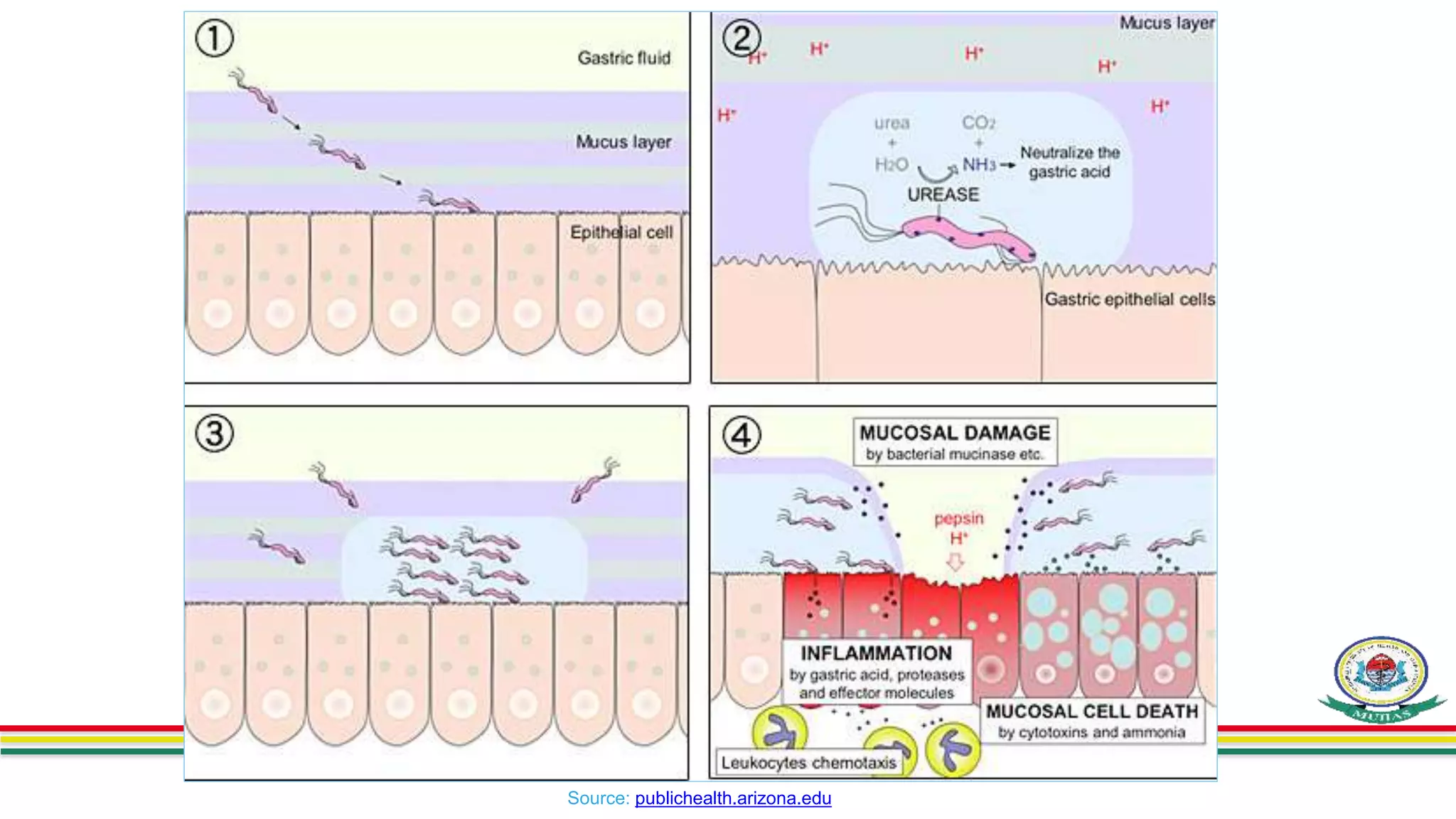 Peptic ulcer pathophysiology | PPTX