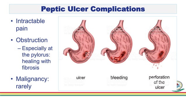Peptic ulcer pathophysiology | PPTX
