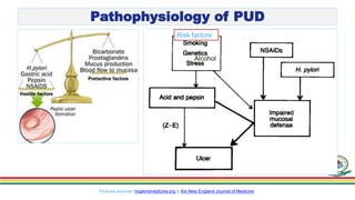 Peptic ulcer pathophysiology | PPT